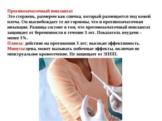 Противозачаточный имплант: цена подкожного контрацептива, отзывы ...